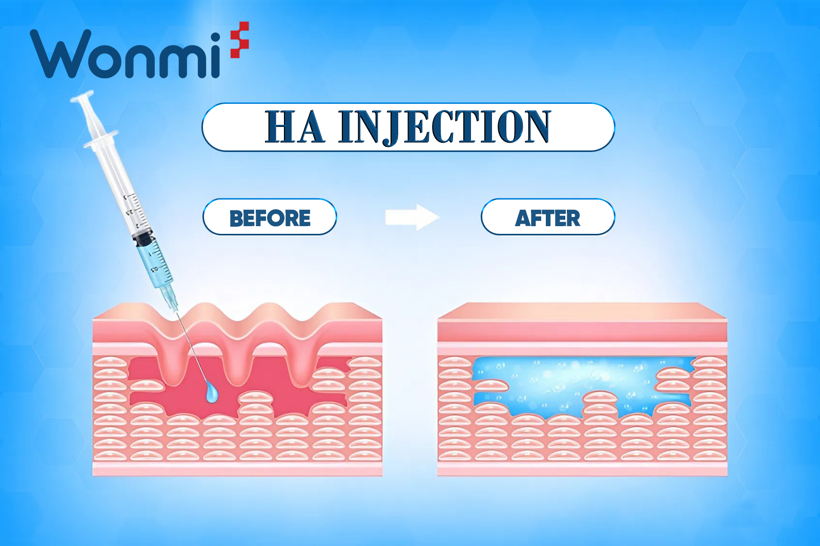 APA ITU HA INJECTION? MEKANISME KERJA DAN MANFAAT SEBENARNYA DARI SUDUT ...