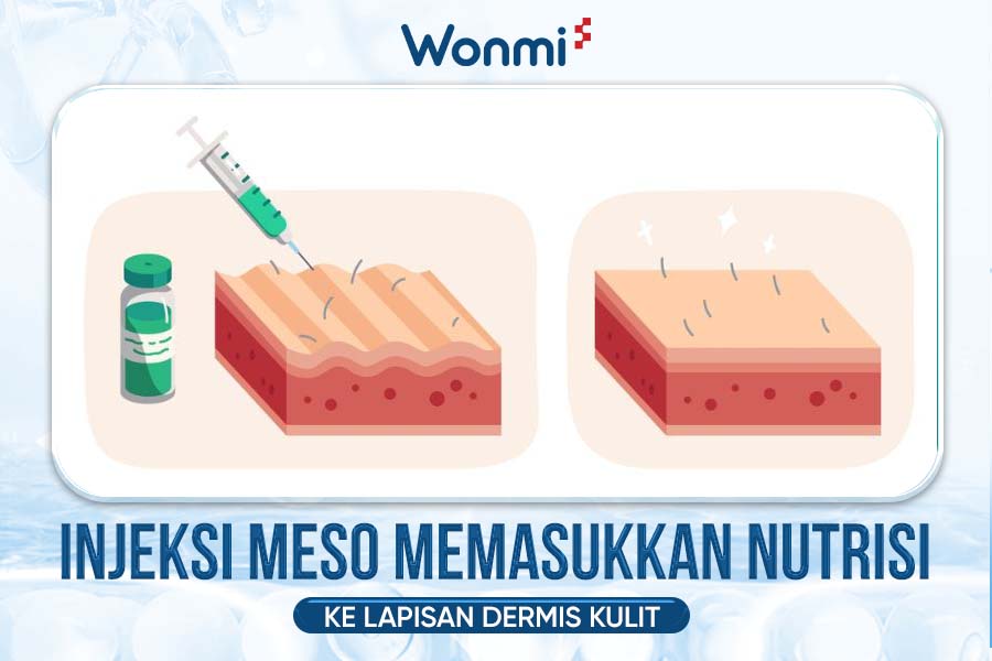 Apa itu Meso Extra? 4 hal yang perlu diketahui tentang metode ...