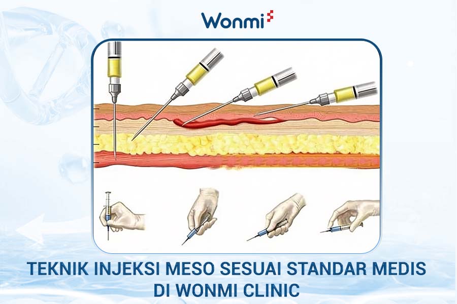 BERAPA LAMA PERLU MELAKUKAN INJEKSI MESO LAGI UNTUK MENJAGA KULIT TETAP ...